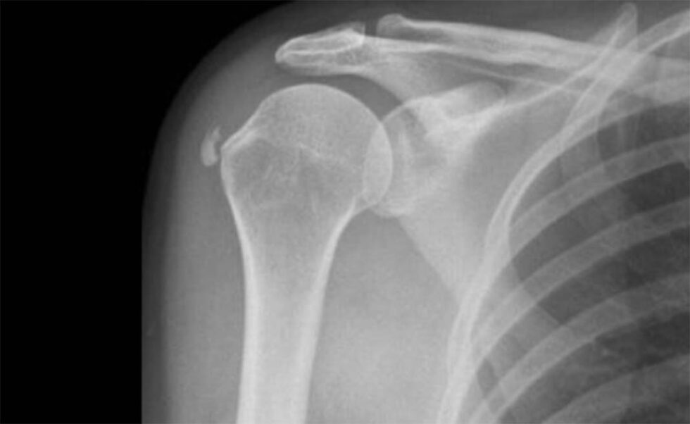 Calcifications à l’épaule - Centre Main Epaule Mediterranée à Marseille