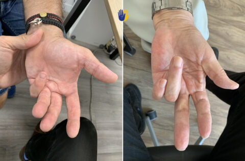 Maladie de Dupuytren - Centre Main Epaule Mediterranée