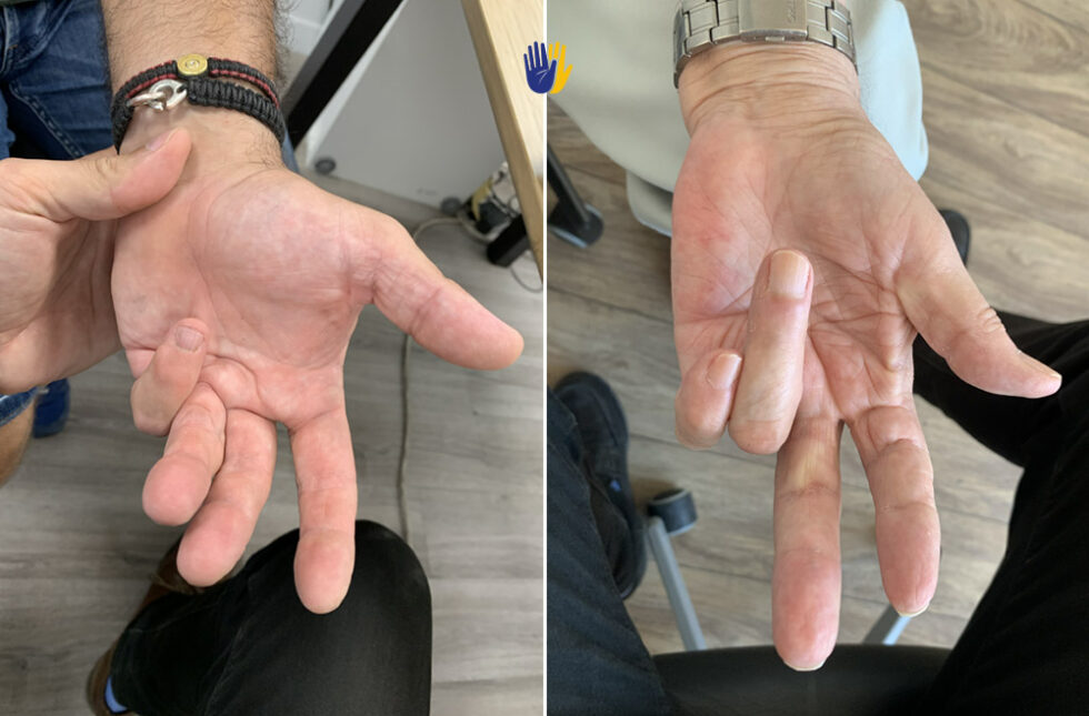 Maladie De Dupuytren Douleur , Qu’est-ce que la maladie de Dupuytren ...